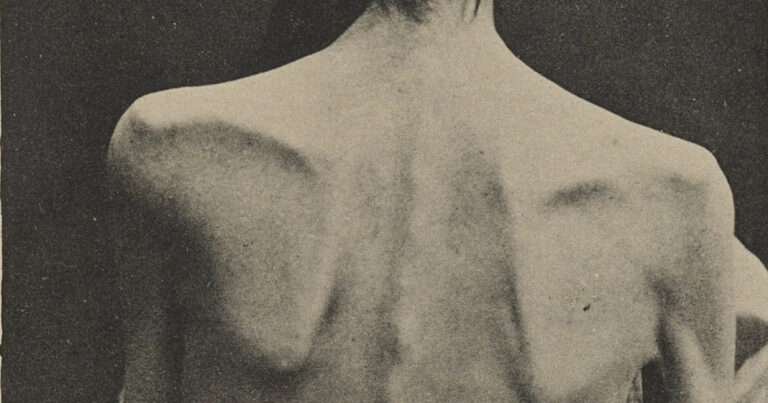 Cachexia: Symptoms, Causes and Treatment | Psychology | 2023