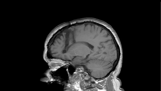 The Effects of Brain Lobotomy: a Summary | 2024